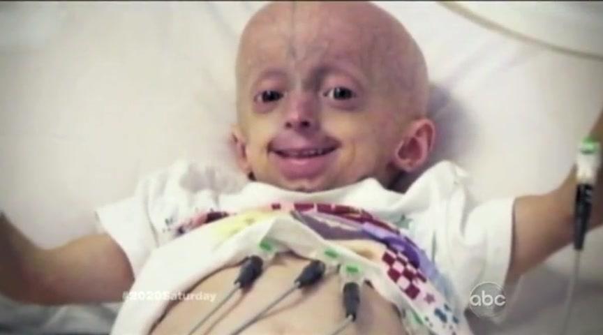Little Girls With a Rapid-Aging Disease Get a Miracle...and Will Steal ...
